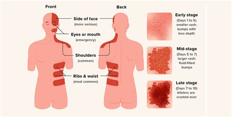 Health Shingles Vaccine To Be Offered On Nhs To Over S And