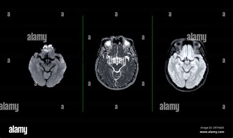 MRI Brain Scan Axial Diffusion Technique For Detect Brain Diseases Sush