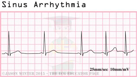 ECG Educator Blog Sinoatrial Node Rhythms