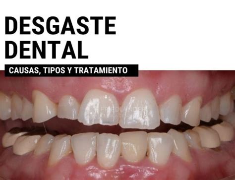 Piorrea Qué es y cómo se cura Clínica dental Friedländer
