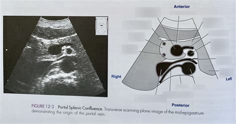 Portal Splenic Confluence Trans Diagram Quizlet