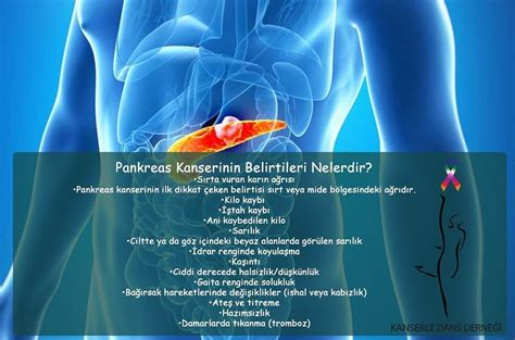 Kanserle Dans Derneği on Instagram Pankreas Kanserinin Belirtileri