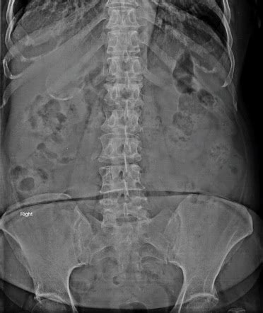 Porcelain Gallbladder Radiology Case Radiopaedia Org