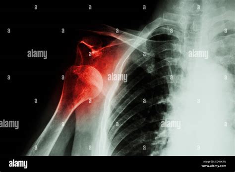 épaulé Banque de photographies et dimages à haute résolution Alamy