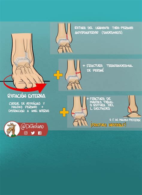 Una simplificación de la clasificación de Lauge Hansen de Fracturas de
