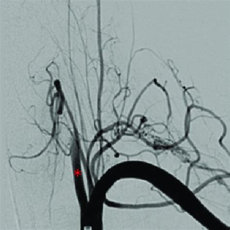 Digital Subtraction Angiography Occlusion Of The Left Vertebral Artery