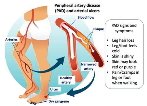Patient Education Arterial Ulcer