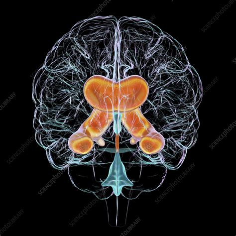 Enlarged Lateral Ventricles Of The Brain Illustration Stock Image