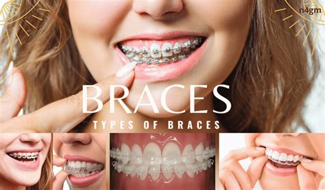 Different Types Of Braces