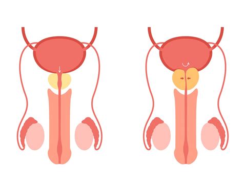 Hiperplasia benigna da próstata urologia Urologista Goiânia Dr