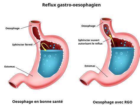 Reflux Gastrique RGO Les Causes Et Traitements