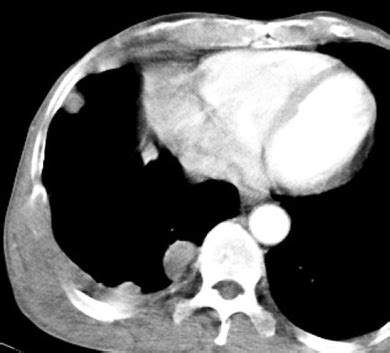 Adenocarcinoma Della Pleura Appunti Di Un Giovane Radiologo