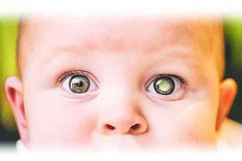Entenda O Retinoblastoma C Ncer Que Afeta Principalmente Crian As