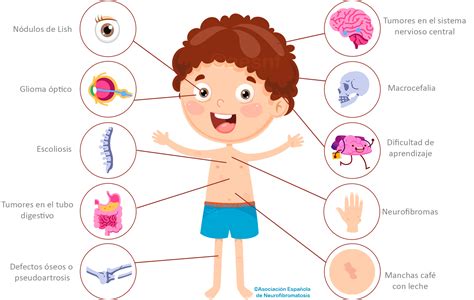 Síntomas de la Neurofibromatosis tipo 1 Asociación Española de