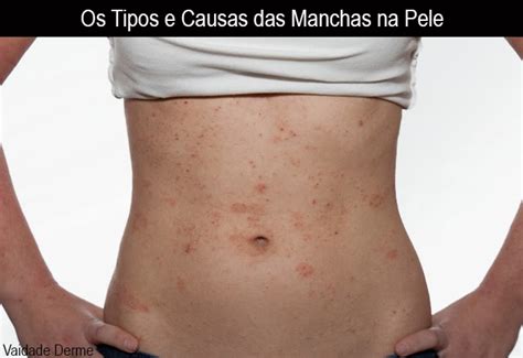 Vaidade Derme Os Tipos E Causas Das Manchas Na Pele Entenda Como A