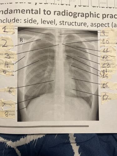 Chest Xray Flashcards Quizlet