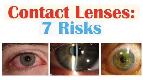 Eye Infection From Contacts
