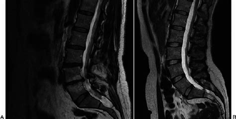 Sagittal T2 Weighted Magnetic Resonance Imaging Of The Lumbar Spine