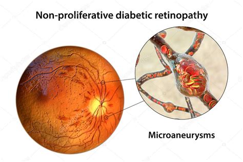 Retinopatía diabética no proliferativa ilustración 3D que muestra