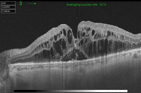 Diabetic Retinopathy Most Frequent Complication Of Diabetes