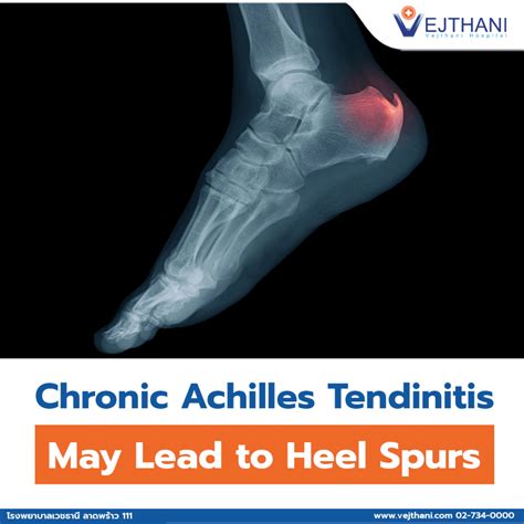 Chronic Achilles Tendinitis May Lead To Heel Spurs