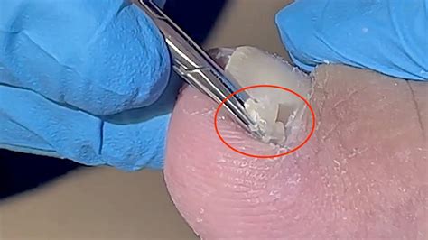 Daily Pedicure TutorialHuge Piece Of Ingrown Nails Hidden Inside