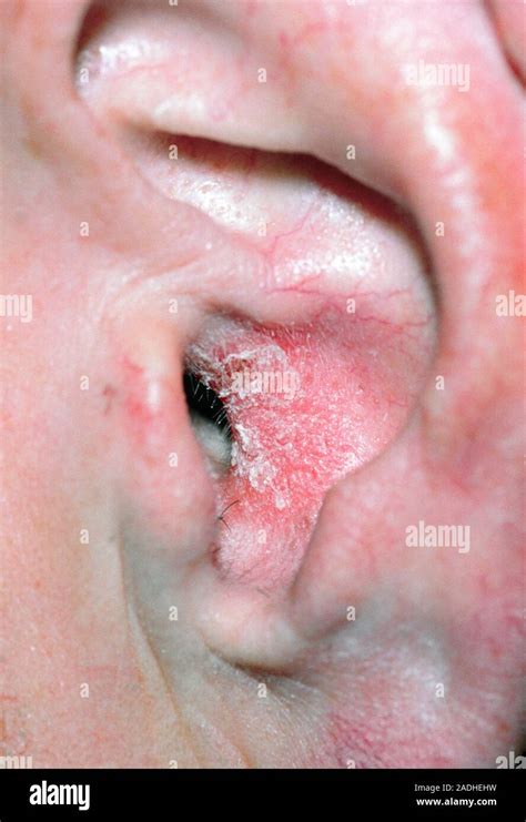 Eczema In The Ear Canal The Skin Is Red With Yellowy White Scaly Patches Eczema Is An