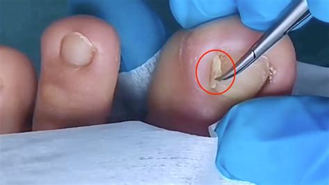 Daily Pedicure Tutorial Pulling Out The Deeply Embedded Ingrown Nail