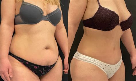 Abdominoplastia Lipoaspiração Caso 18240