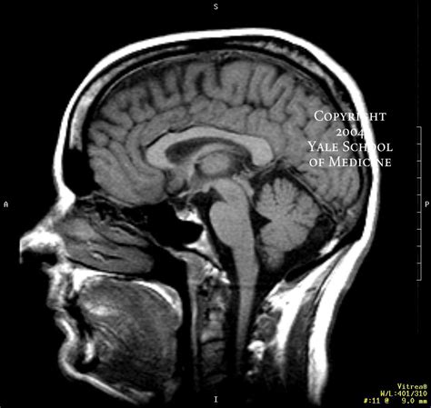 Sagittal View Of Brain Mri