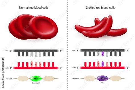 Sickle Cell Disease Normal Red Blood Cells And Sickled Red Blood Cells