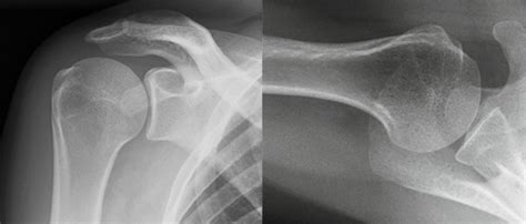 Shoulder Osteoarthritis Zahab Ahsan MD