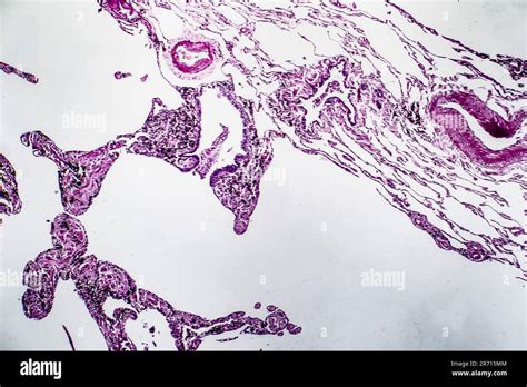 Histopathology Of Lung Emphysema Light Micrograph Photo Under