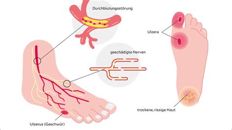 Diabetisches Fußsyndrom YouTube