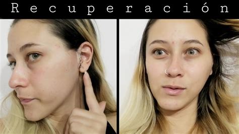 RECUPERACIÓN cirugía ortognática maxilofacial artrectomía de ATM