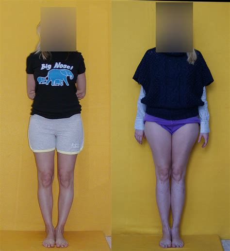 Leg Shortening Surgery Recovery Timer