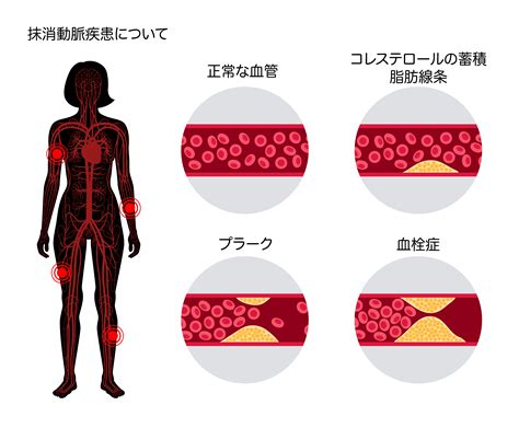 膠原病性難治性潰瘍について閉塞性動脈硬化症に伴う潰瘍との違い NPO法人血管医学研究推進機構