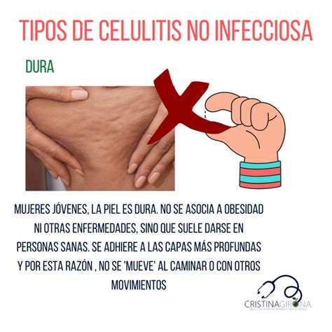 Qu Es La Celulitis Y C Mo Tratarla Doctora Cristina Girona