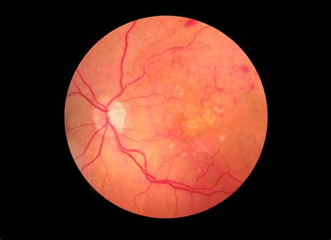 Retinal Examination