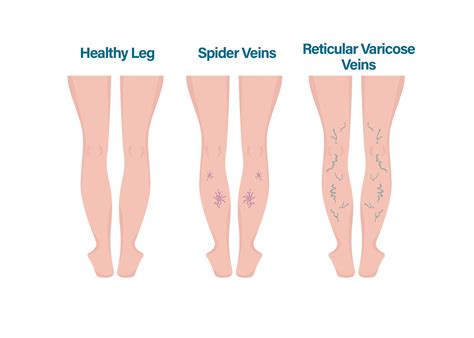 Varicose Veins Symptoms And Treatment Options Physicians Vein Clinics