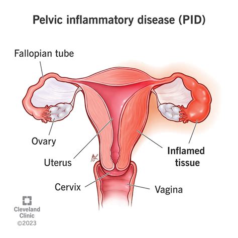 What Is Pelvic Inflammatory Disease PID Causes And