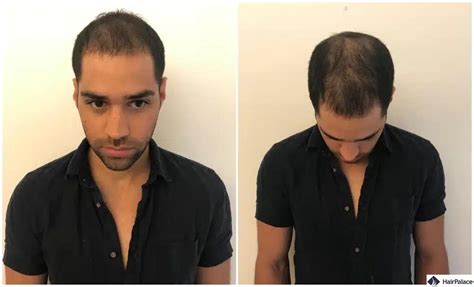 Greffe de Cheveux Évolution Mois par Mois