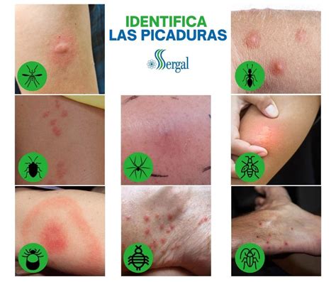 Diferencia Las Picaduras De Los Insectos SERGAL SERGAL