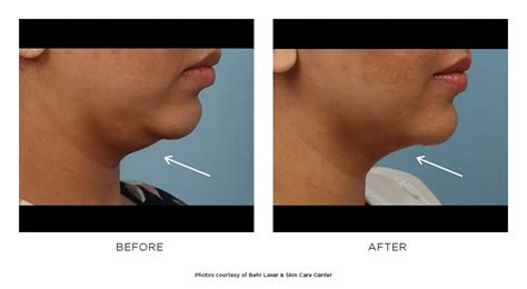 Ultherapy Before After Photos Behr Laser Skin Care Center