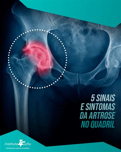 O Que Artrose De Quadril Entenda As Causas Sintomas E Tratamentos