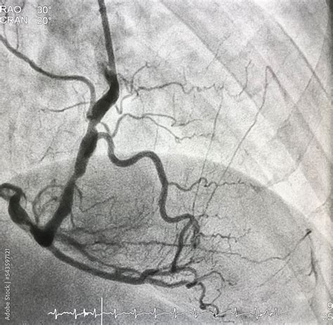 Coronary Angiogram CAG Shown Right Coronary Artery Stenosis And Given