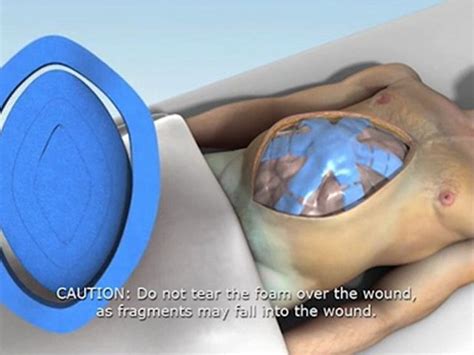 Pdf Successful Use Of Negative Pressure Wound Therapy For Off