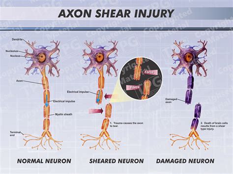 Axon Shear Injury