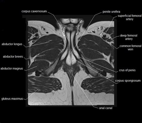 MRI Pelvis Anatomy Free Male Pelvis Axial Anatomy