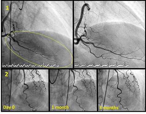 Spontaneous Coronary Artery Dissection Contemporary Aspects Of
